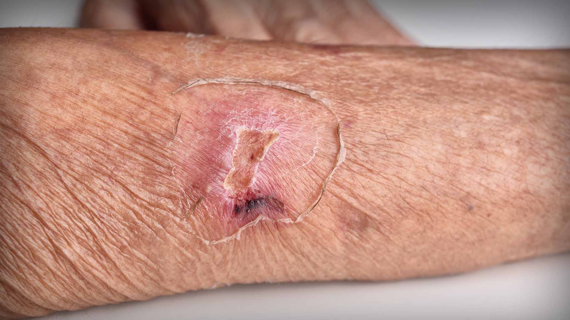 Wound management – Australian Health Journal